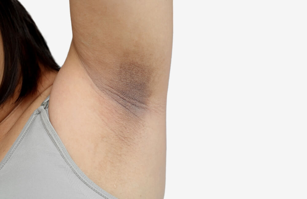 Haut der Achselhöhlen aufhellen - Besser Gesund Leben