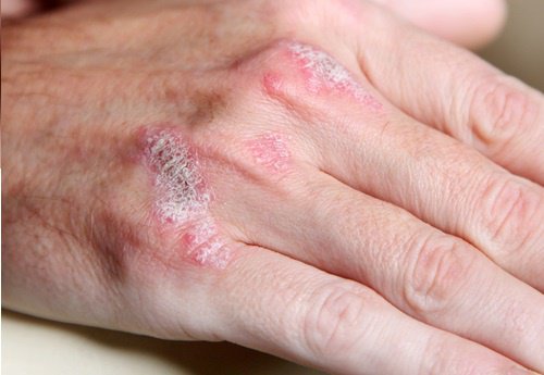 5 Aspekte über Autoimmunkrankheiten, die man kennen sollte