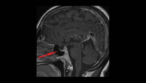 Wissenswertes über das Hypophysenadenom - Besser Gesund Leben