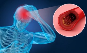 Apoplexie: Risikofaktoren und Symptome - Besser Gesund Leben